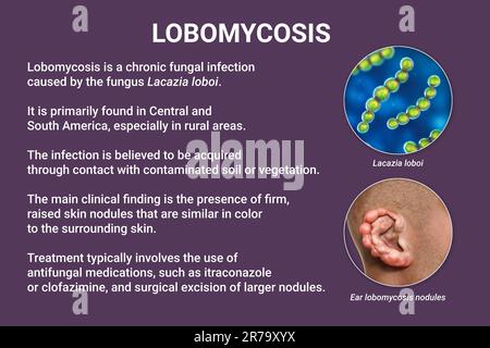 Lobomycosis, a chronic skin disease caused by microscopic fungi Lacazia ...