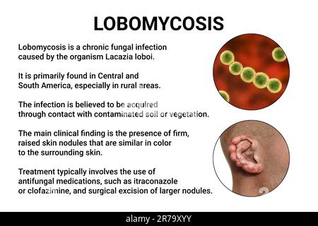 Lobomycosis, a chronic skin disease caused by microscopic fungi Lacazia ...