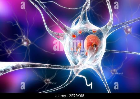 Illustration showing Lewy bodies (red) in neurons (blue) with a close ...