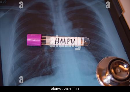Background of Human Metapneumovirus (HMPV) RT-PCR Kit ,Medical health ...