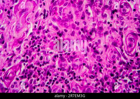 Kidney inflammation. Light micrograph of kidney tissue in a case of ...