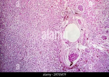 Post streptococcal glomerulonephritis Stock Photo - Alamy