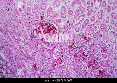 Post streptococcal glomerulonephritis Stock Photo - Alamy