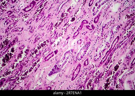 Systemic lupus erythematosus. Light micrograph of a section through a ...