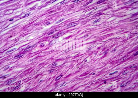 Uterine fibroid. Light micrograph (LM) of a section through tissue from ...