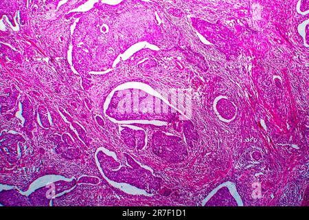 Cervical cancer. Light micrograph (LM) of a section through a squamous ...