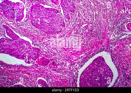 Cervical cancer. Light micrograph (LM) of a section through a squamous ...