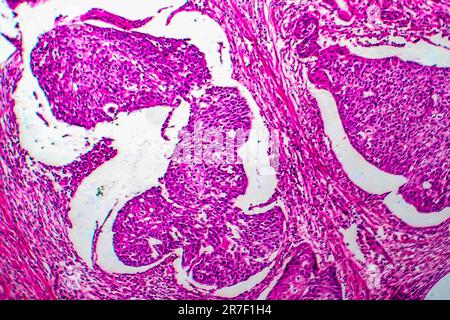 Cervical cancer. Light micrograph (LM) of a section through a squamous ...