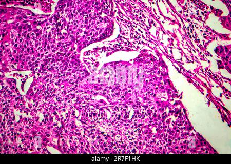 Cervical cancer. Light micrograph (LM) of a section through a squamous ...