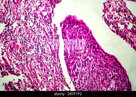 Cervical cancer. Light micrograph (LM) of a section through a squamous ...