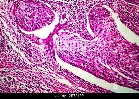 Cervical cancer. Light micrograph (LM) of a section through a squamous ...