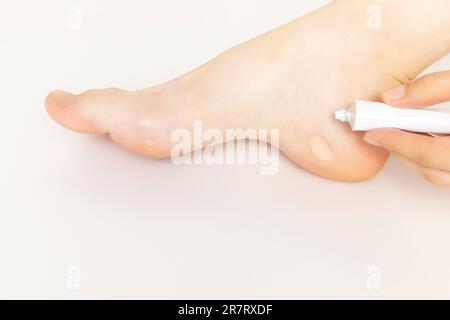 Person Shows Foot with Calluses, Skin Corns on Heel and Phalange of Toe ...