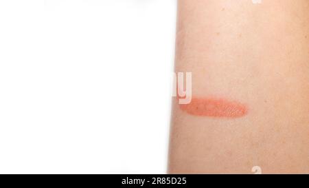 Close up burning skin on arm, Injury from fire Stock Photo - Alamy