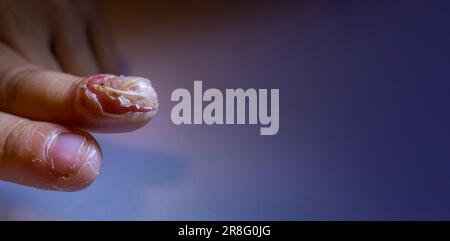 finger swollen with inflammation due to Nail ripped infection Stock ...