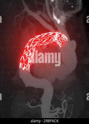 CTA whole aorta with thoracic aorta stent graft 3D rendering image in ...