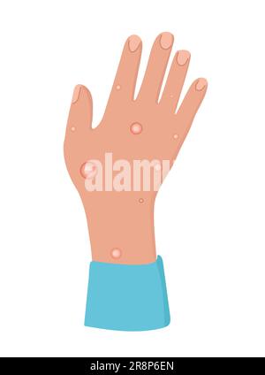 Hand drawn smallpox virus isolated on white background. Realistic ...