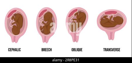 Different wrong baby positions in uterus during pregnancy. Cephalic ...