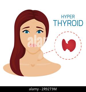 Thyroid disorder, conceptual illustration Stock Photo - Alamy