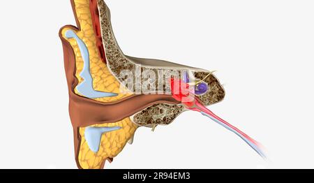 Acute otitis media is an infection and inflammation of the middle ear ...