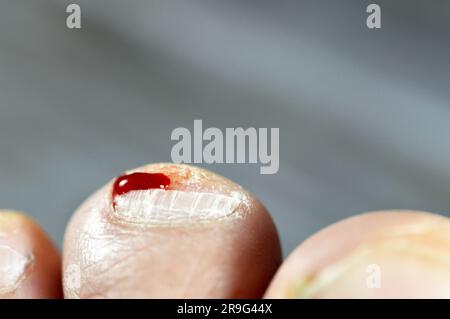 Bleeding on the tip of the second toe of the left foot, insult of the ...