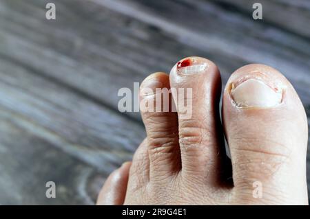 Bleeding on the tip of the second toe of the left foot, insult of the ...
