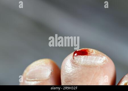 Bleeding on the tip of the second toe of the left foot, insult of the ...