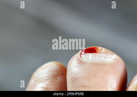 Bleeding on the tip of the second toe of the left foot, insult of the ...