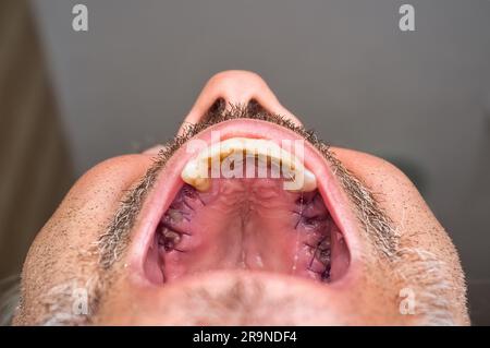 Detail of the upper male palate with the gum stitched after the ...