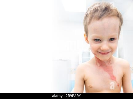 dressing a boy with a burn from boiling water Stock Photo - Alamy