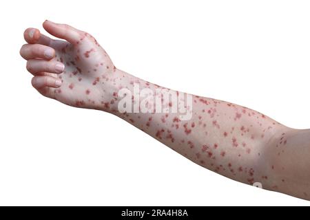 Rash in Marburg haemorrhagic fever, illustration Stock Photo - Alamy