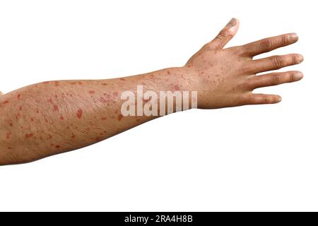 Rash in Marburg haemorrhagic fever, illustration Stock Photo - Alamy