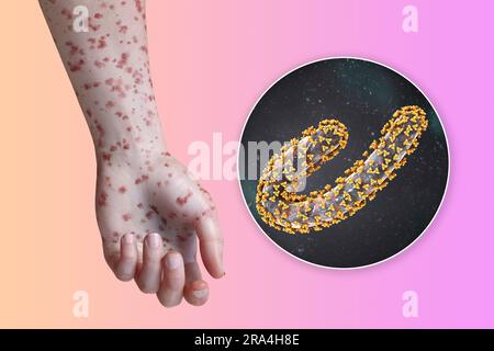 Rash in Marburg haemorrhagic fever, illustration Stock Photo - Alamy