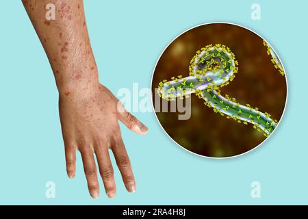 Rash in Marburg haemorrhagic fever, illustration Stock Photo - Alamy