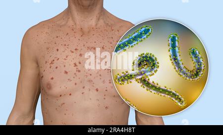 Rash in Marburg haemorrhagic fever, illustration Stock Photo - Alamy