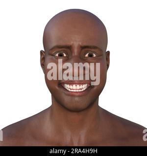 Lockjaw in tetanus, illustration Stock Photo - Alamy