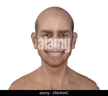 Lockjaw in tetanus, illustration Stock Photo - Alamy