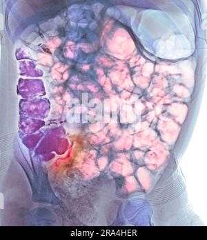 Healthy appendix. Coloured X-ray of the human appendix and colon (large ...