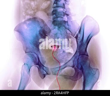 Blocked fallopian tube, X-ray Stock Photo - Alamy