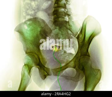 Blocked fallopian tube, X-ray Stock Photo - Alamy