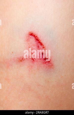Flesh wound Scab on knee and scar because of falling Stock Photo - Alamy