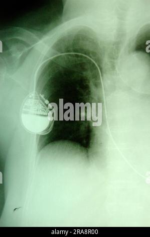 Heart pacemaker, X-ray Stock Photo - Alamy