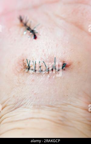 Seam Wound Body Stock Photo - Alamy