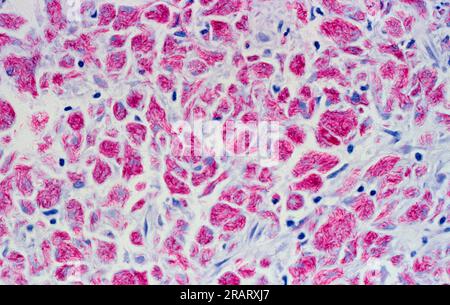 Lymph node: Mycobacterium avium-intracellulare Stock Photo - Alamy