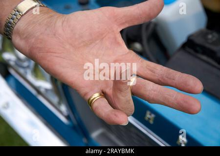 Dupuytren contracture affecting the left hand Stock Photo - Alamy