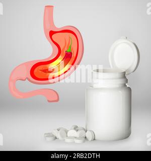 Heartburn treatment. Antacid pills and illustration of unhealthy ...
