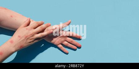 Monkeypox new disease dangerous over the world. Monkeypox virus ...