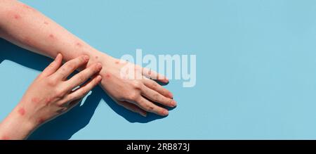 Monkeypox new disease dangerous over the world. Patient with Monkey Pox ...