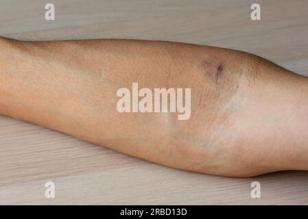 Bruise or ecchymosis of Asian man arm from needle after blood drawn for ...