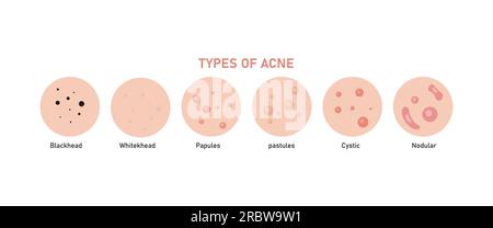 Types of acne pimples. Whiteheads, Blackheads, Papules and Pustules ...