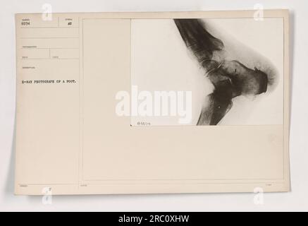 X-ray photograph of a foot taken during World War One. The image is ...